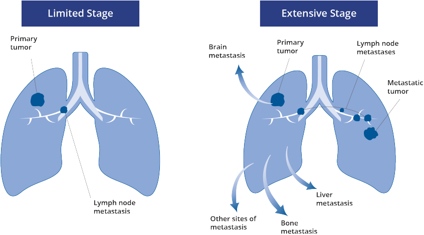 What is Small Cell Lung Cancer (SCLC)? | TECENTRIQ® (atezolizumab)